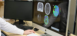 Research projects to pave way for survivors of stroke | Mirage News